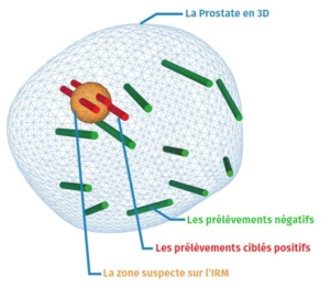 Quoi de neuf en Urologie à la clinique du Cèdre ? - Clinique du Cèdre